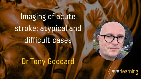 Imaging in Acute Stroke: Atypical & Difficult Cases | everlearning ...